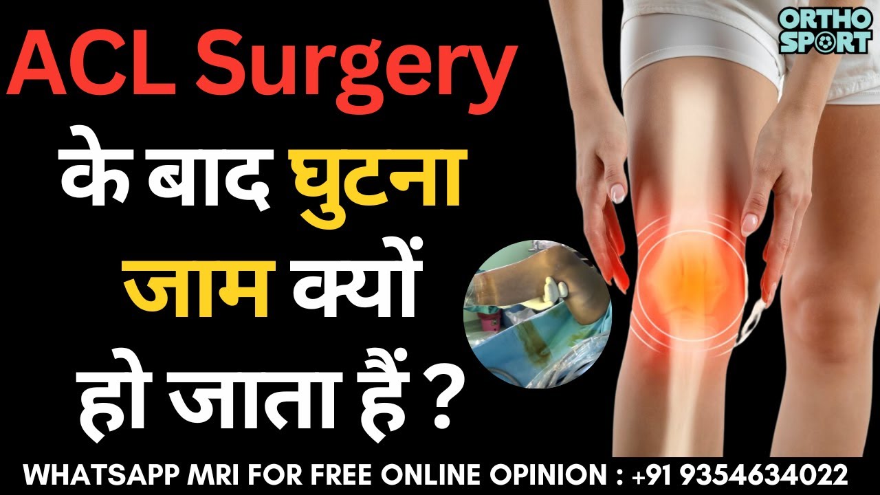 ACL Surgery के बाद घुटना जाम क्यों हो जाता हैं ? Why does the knee ...