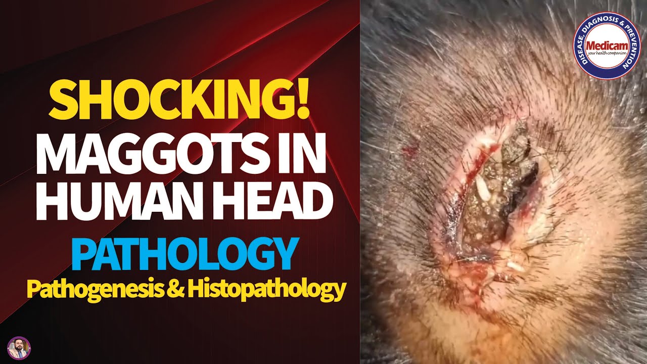 Shocking Maggots in Human Cranial | Pathogenesis & Histopathology - YouTube