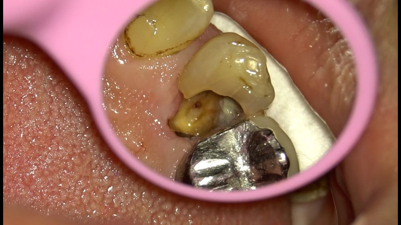How to fix a broken tooth case 1 - YouTube