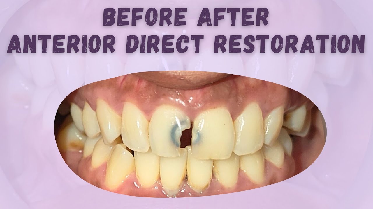 WDC_BEFORE AFTER ANTERIOR DIRECT RESTORATION | COMPOSITE RESTORATION ...