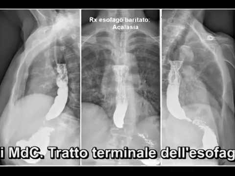Trattamento endoscopico dell'Acalasia: dilatazione pneumatica - YouTube