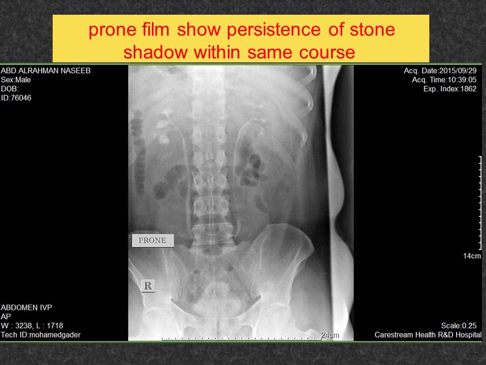 CASE 64 IVP Delayed faint persistent left nephrogram Dr AHMED ESAWY ...