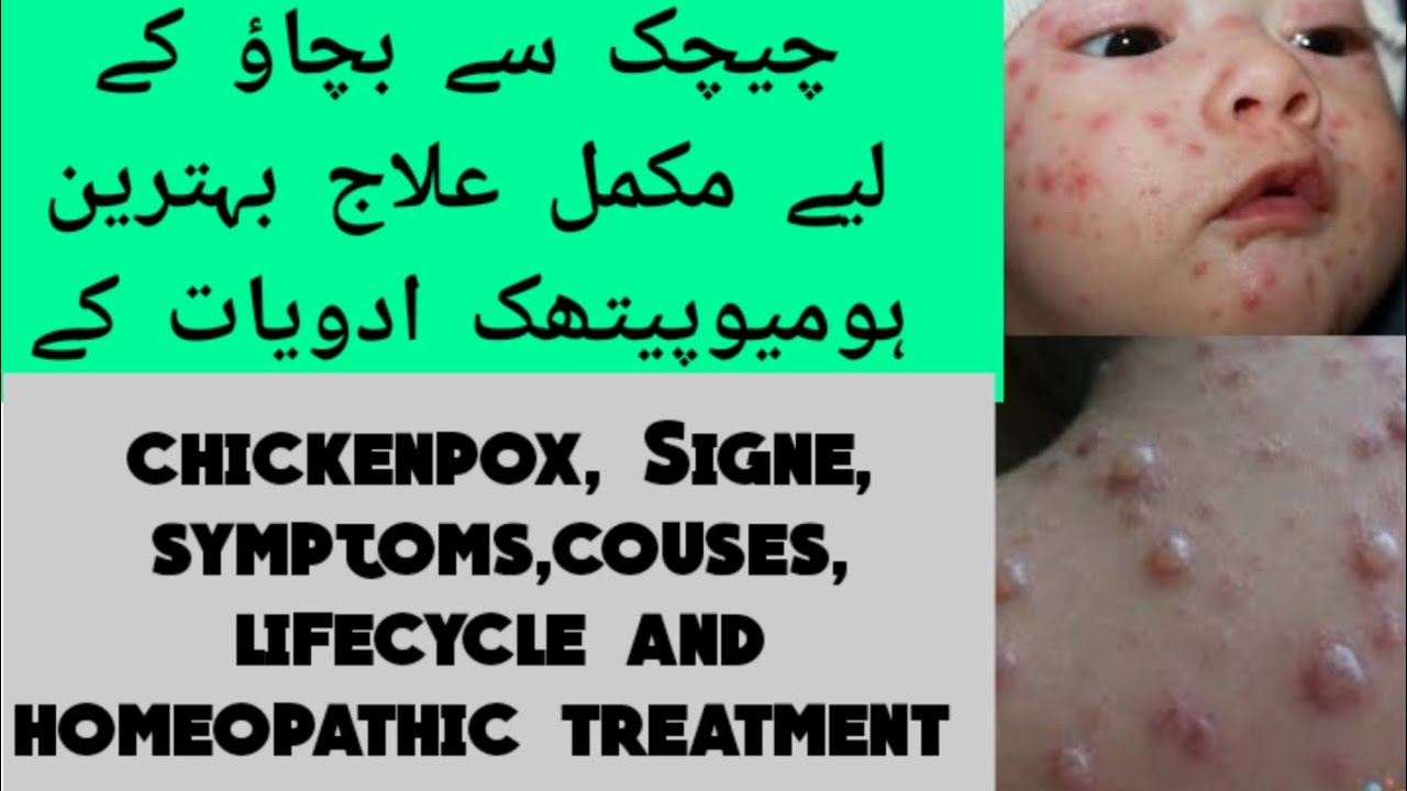 how to care from chickenpox, diagnosis,courses,signs, symptoms ...