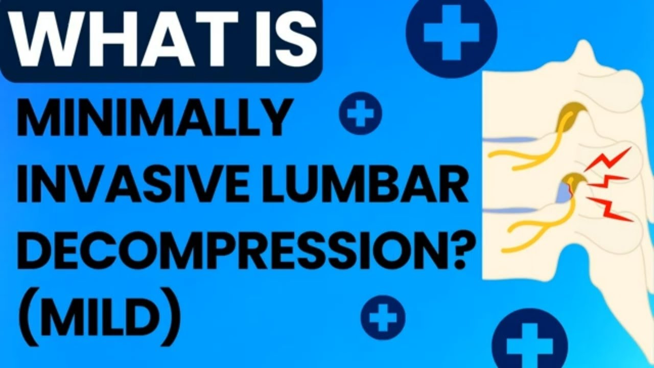 Minimally Invasive Lumbar Decompression (MILD) explained by Board ...