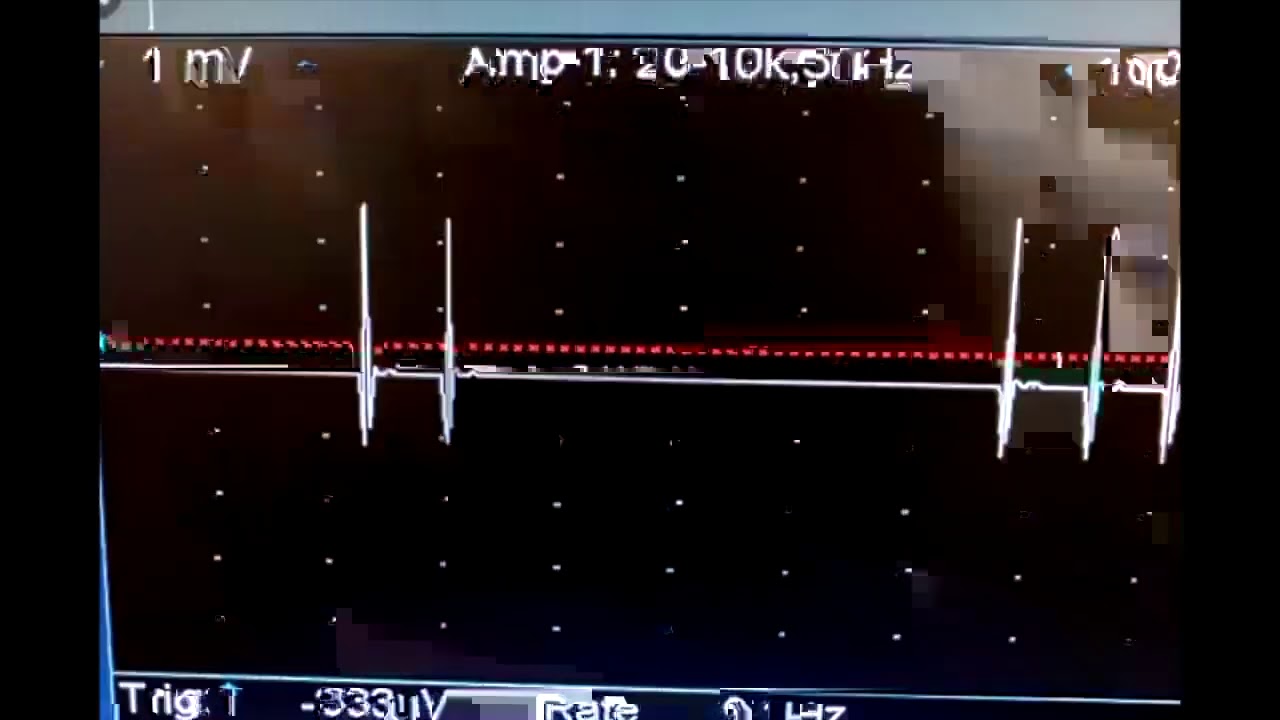 Multiple discharges of a single motor unit (doublets, triplets ...