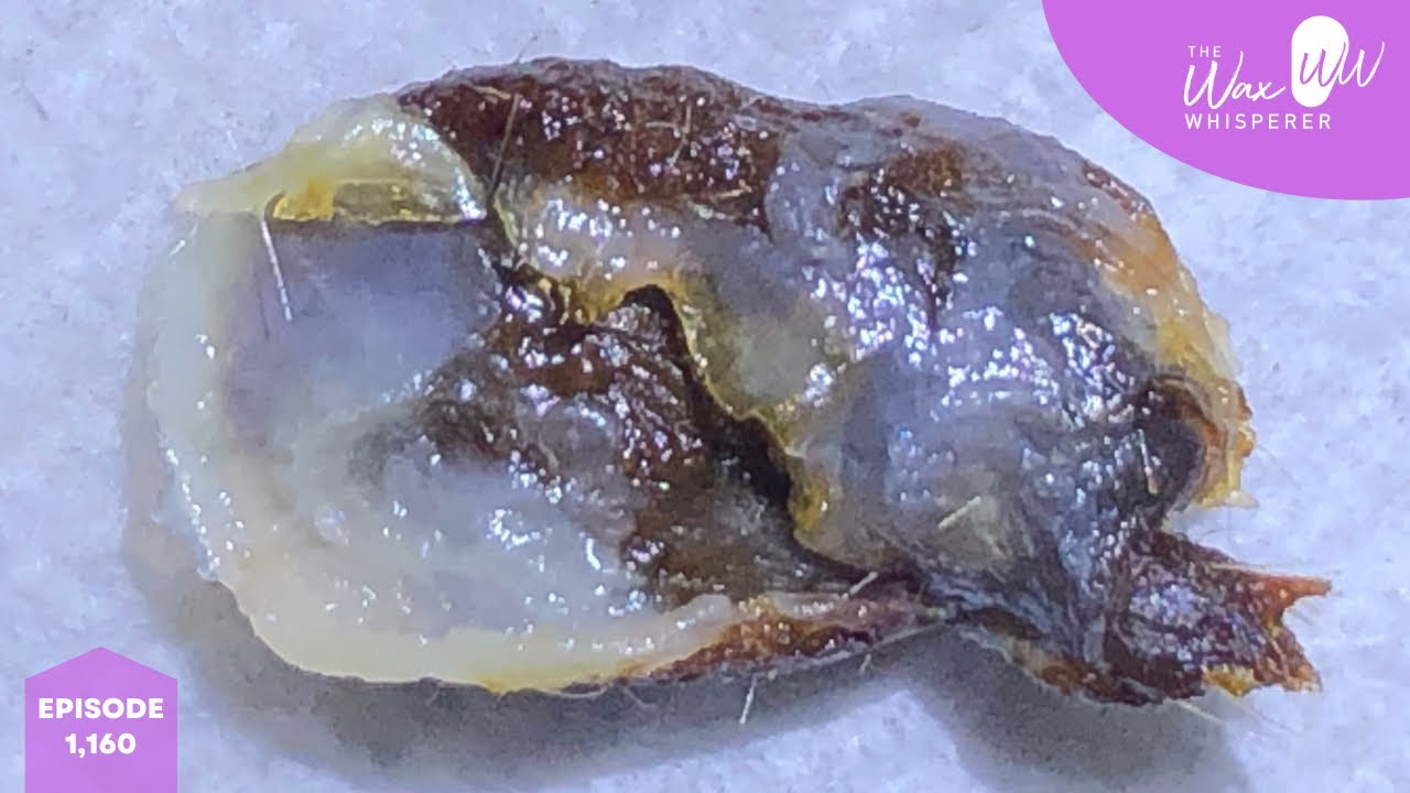 1,160 - Fully Blocked & Sealed Ear Wax Removal - YouTube