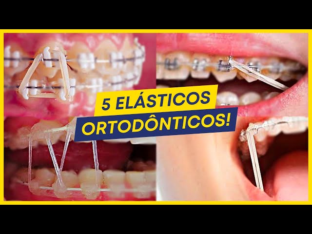 Aparelho Damon Com Elasticos Novidades Em Aparelhos Ortodônticos Na