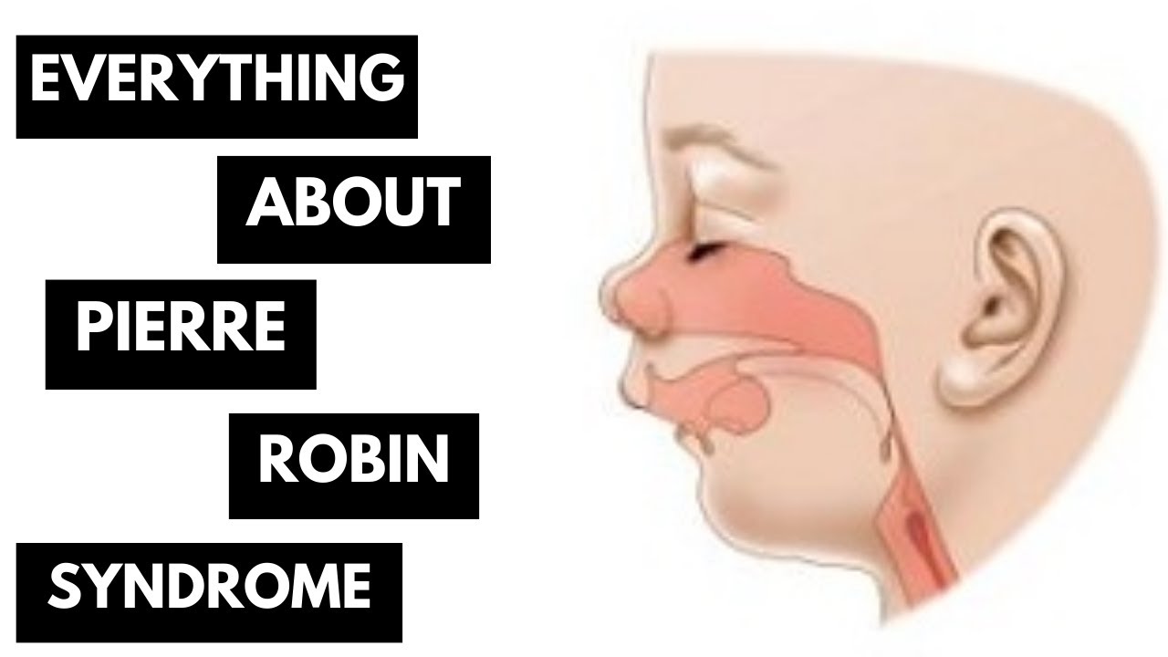 From Identifying to Management of Pierre Robin Sequence - A Must Watch ...
