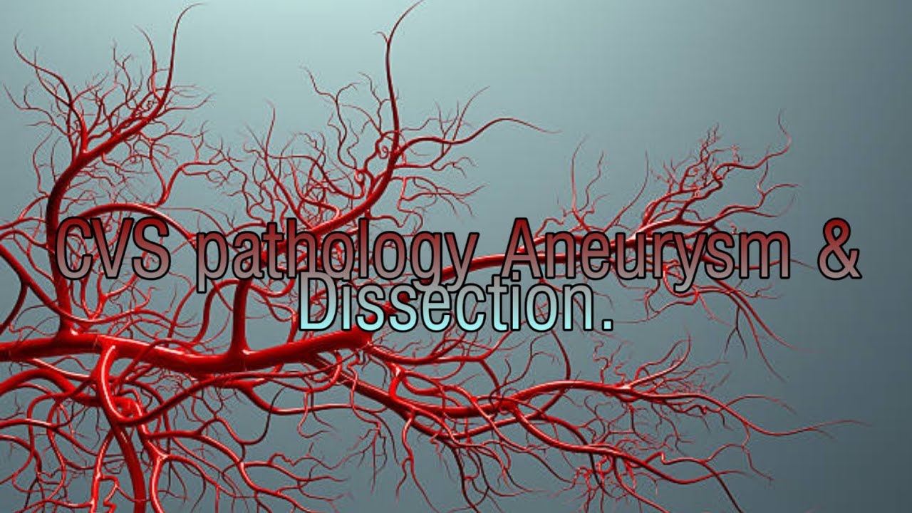 CVS pathology lecture: Aneurysm and dissection - YouTube