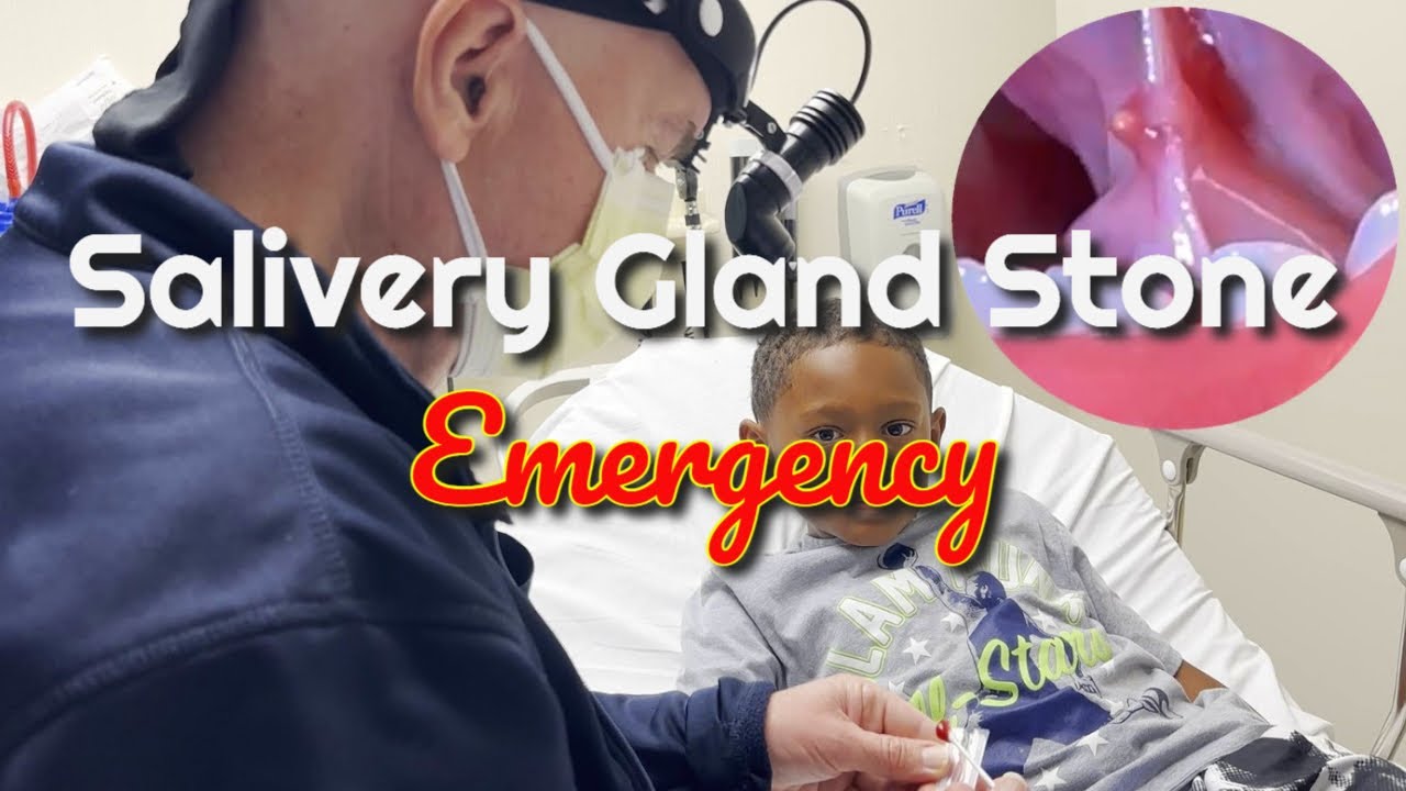 A Six-Year-Old Male with a Rare Salivary Gland Stone - YouTube
