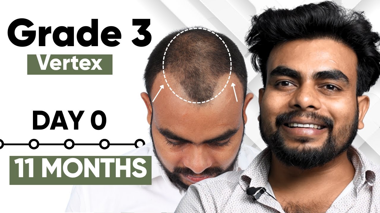Grade 3 Hair Transplant Result | Grade 3 Vertex Baldness | QHT Clinic ...