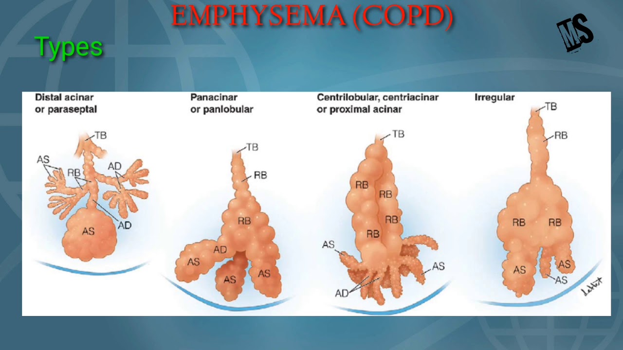 Emphysema (COPD)!!! by medSap!!! - YouTube