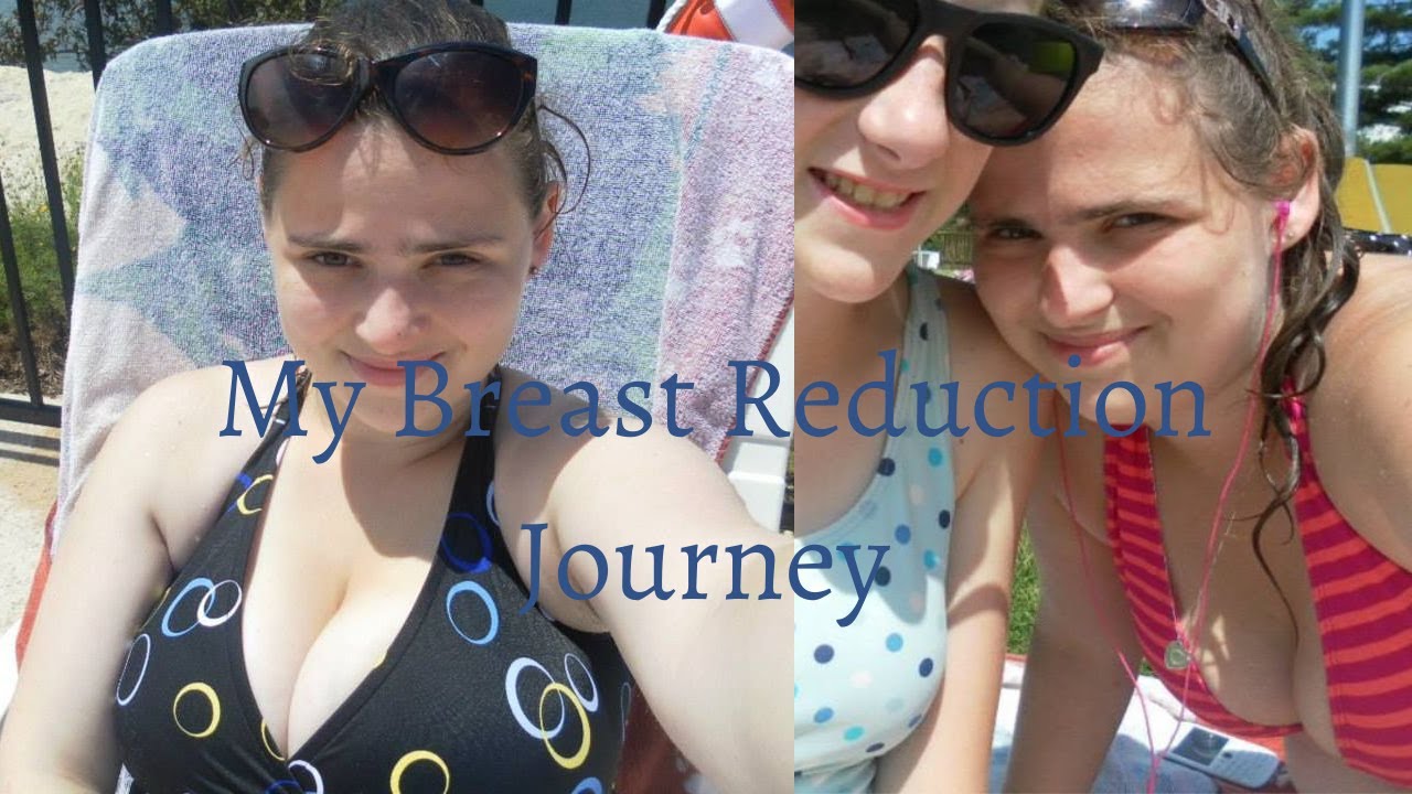 My Breast Reduction Journey Story Youtube