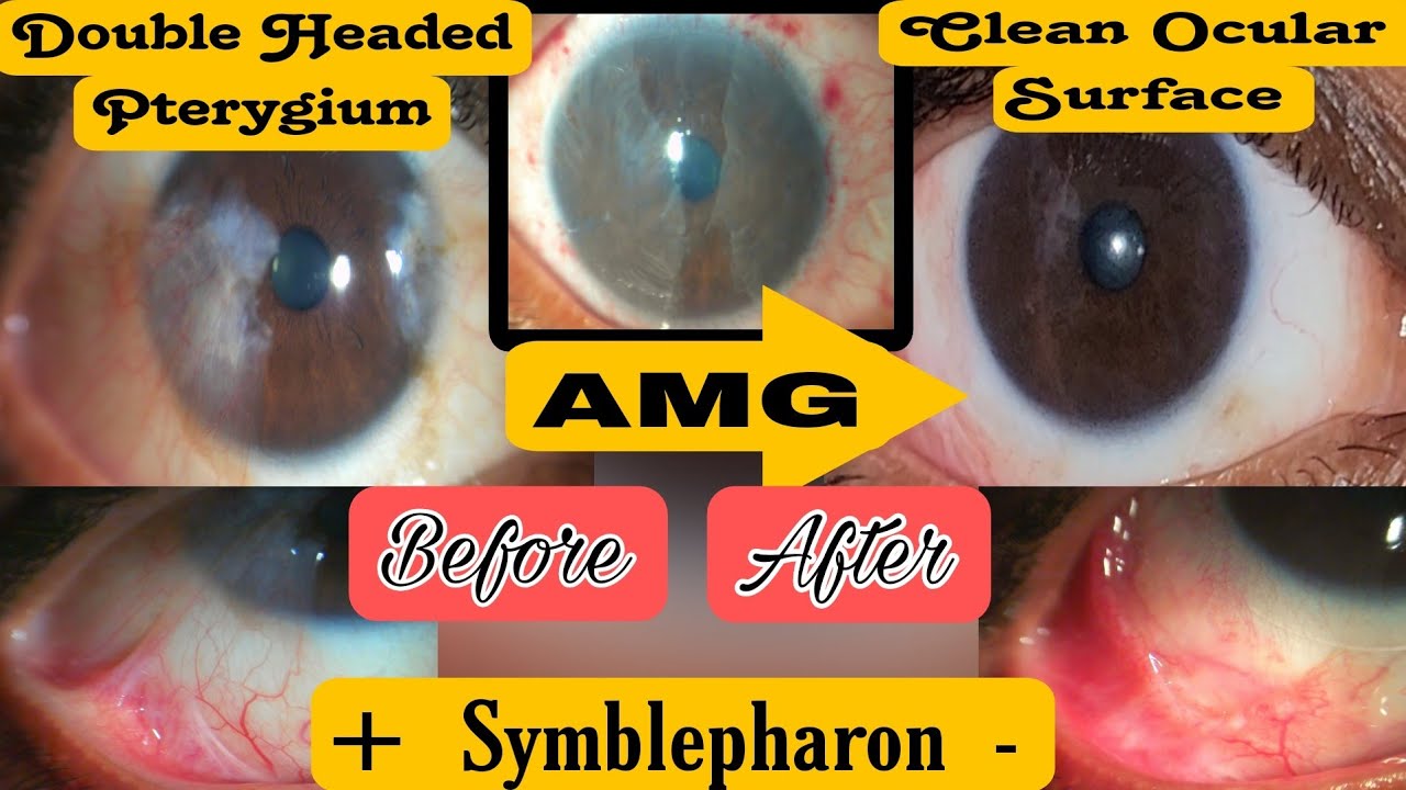 174-double-headed-pterygium-excision-dry-amniotic-membrane-grafting