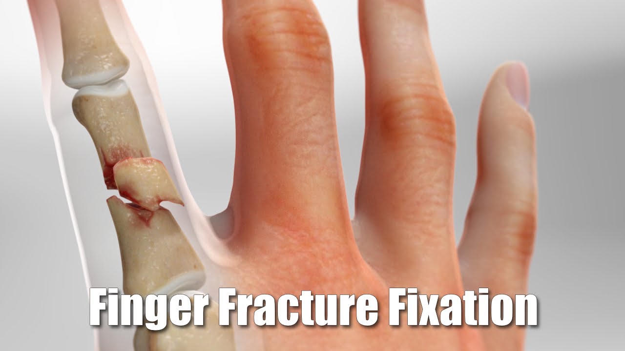Finger Fracture Fixation (3D Animation) - YouTube