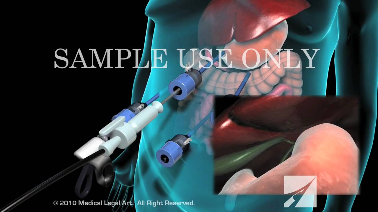 Roux-en-Y Gastric Bypass - YouTube