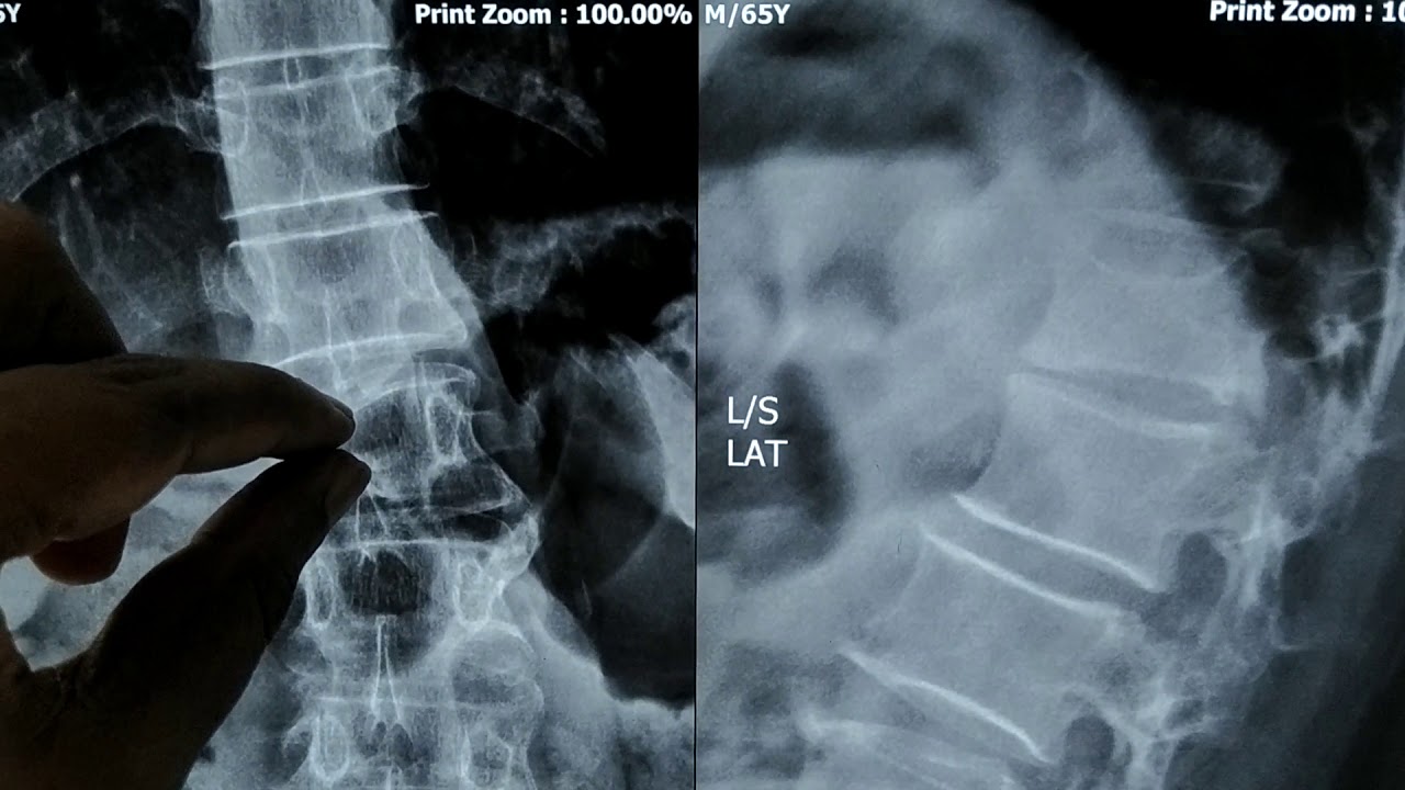 Compression Fracture of Lumber Spine : X Ray finding / Low Back Pain ...