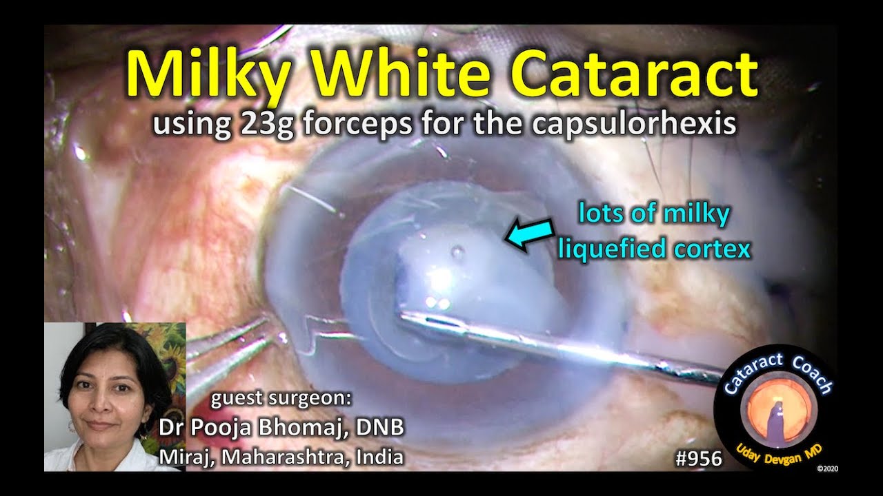guest surgeon milky white cataract surgery - YouTube
