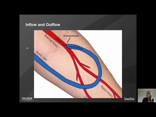 Dialysis Graft Ultrasound