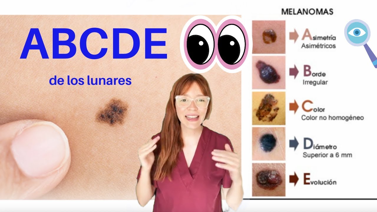ABCDE de los lunares - YouTube