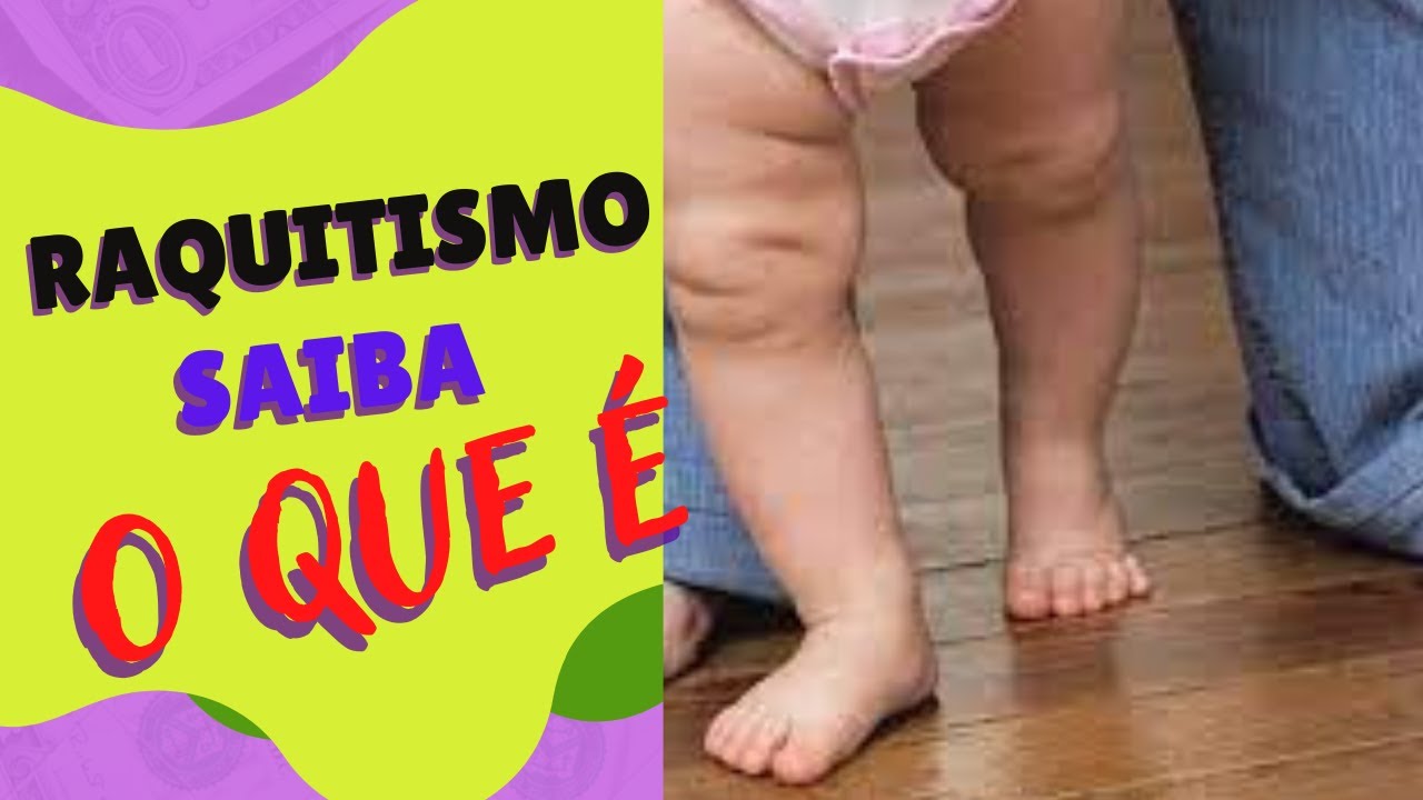 Raquitismo saiba o que é - YouTube