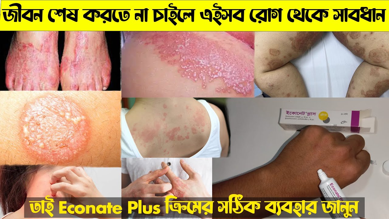 Econate Plus ক্রিমের সঠিক ব্যবহার জানুন |ringworm | tinea cruris ...