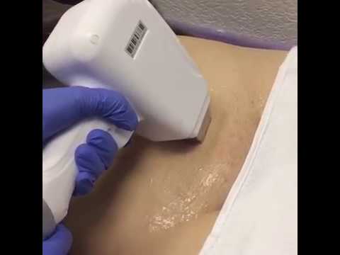 Brazilian laser waxing review