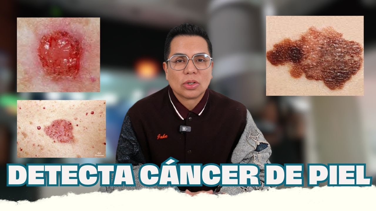 CÁNCER DE PIEL: JAVIER DERMA explica cómo IDENTIFICAR esta ENFERMEDAD ...