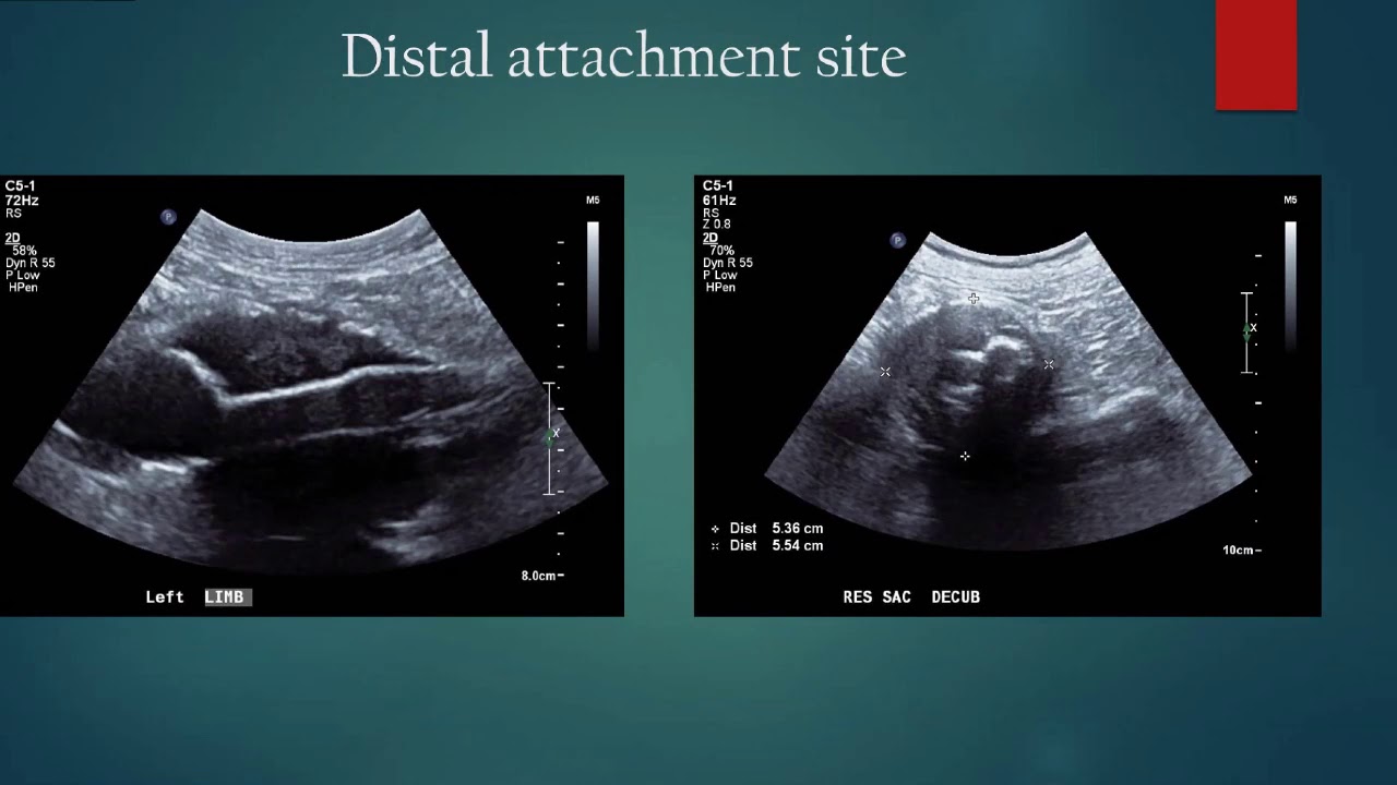Performing Ultrasound Evaluations on Aorta Endografts (EVAR) - YouTube