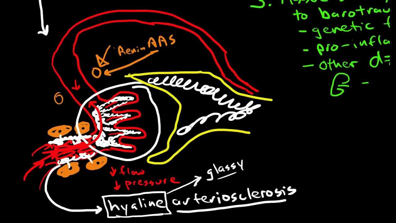 Pathophysiology of Hypertensive Nephropathy - YouTube