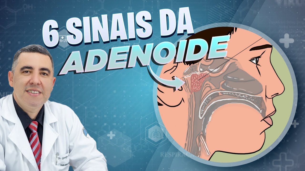 6 sinais da ADENOIDE HIPERTROFIADA para você ficar atento(a) em seus ...