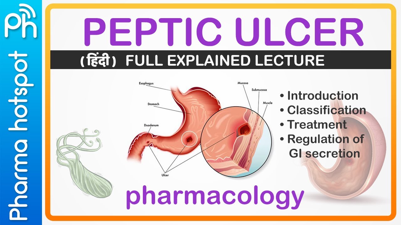 Peptic ulcer disease - causes, classification, diagnosis, treatment ...