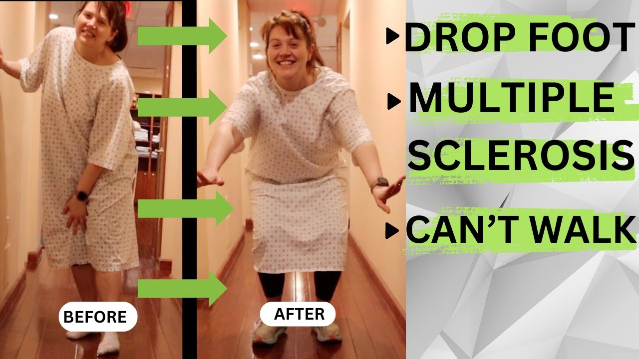 MS Patient’s Drop Foot FIXED by Chiropractic Adjustment | Hip & Spine ...