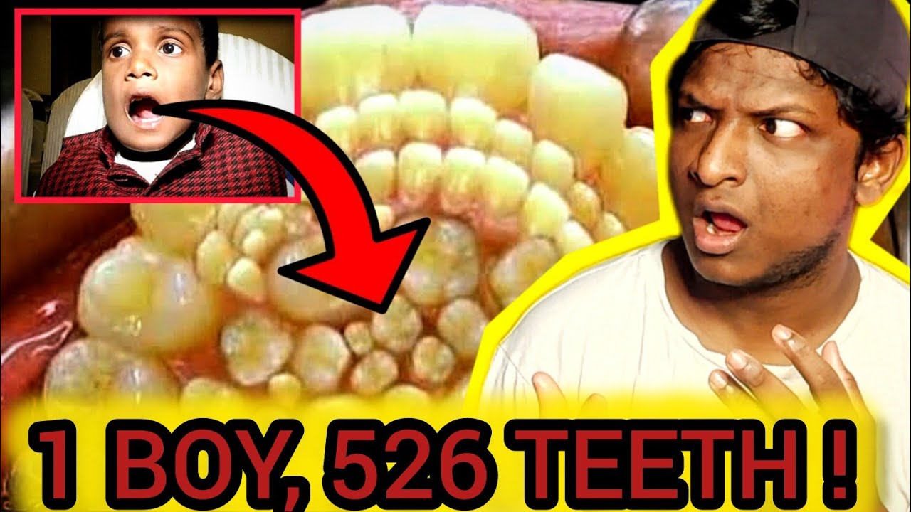 7-Year-Old Boy Has 526 Teeth Removed From His Mouth - YouTube