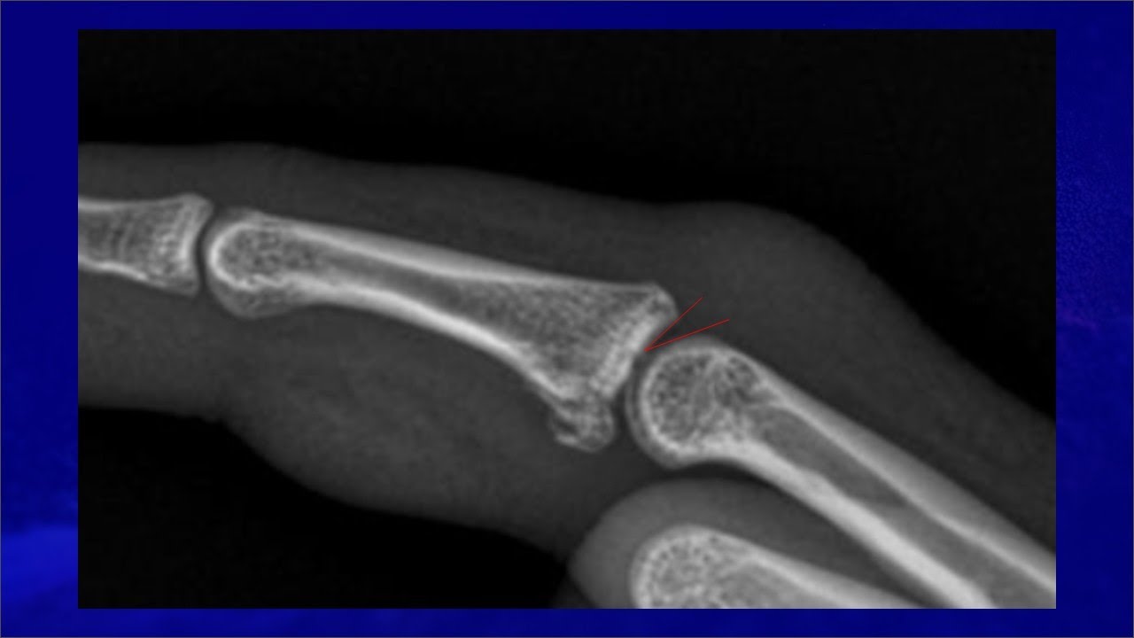 Percutaneous Fixation of a Dorsal Fracture–Dislocation of the Proximal ...