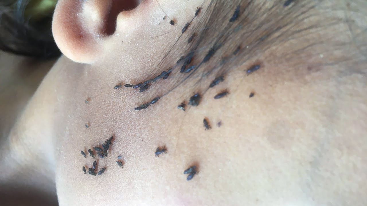There are a lot of head lice hide under hair - Remove many head lice ...