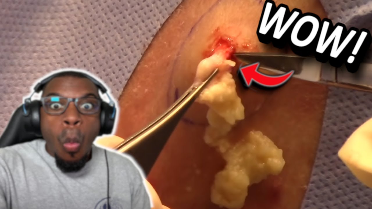LOOK AT THIS EXPLODING CYST POP! | Dr. Derm REACTION! - YouTube
