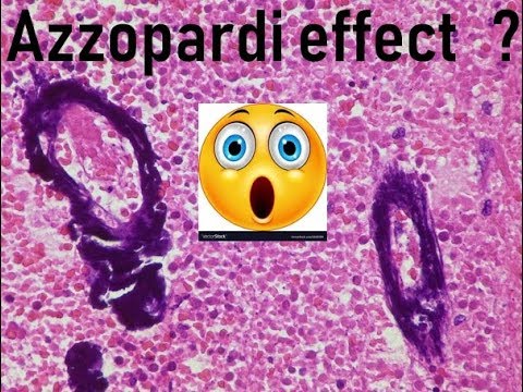 Azzopardi effect:#Medschooltutorial - YouTube