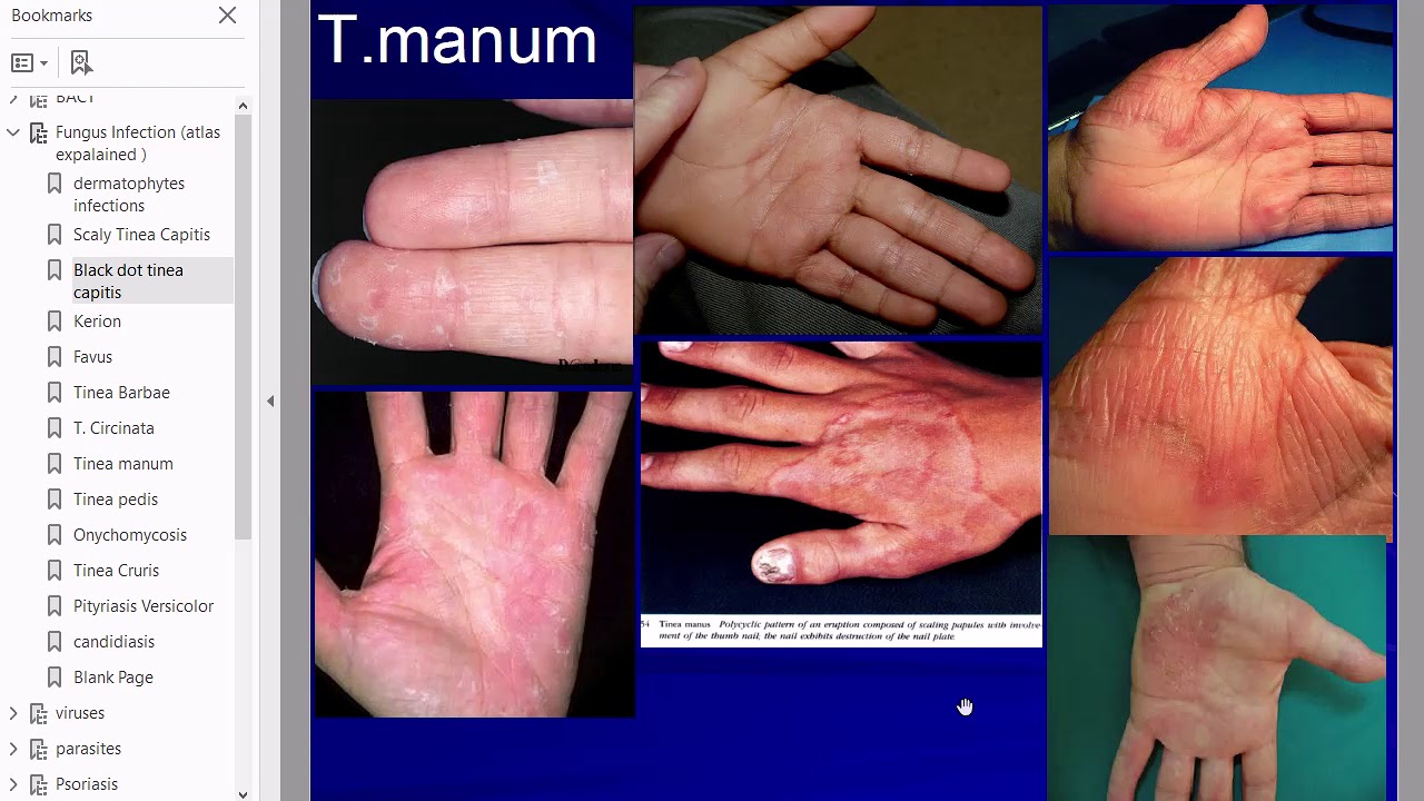 Tinea (Dermatophytes iNfection) - YouTube