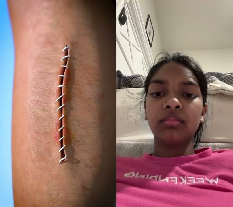 This is what happens when you get stitches - YouTube