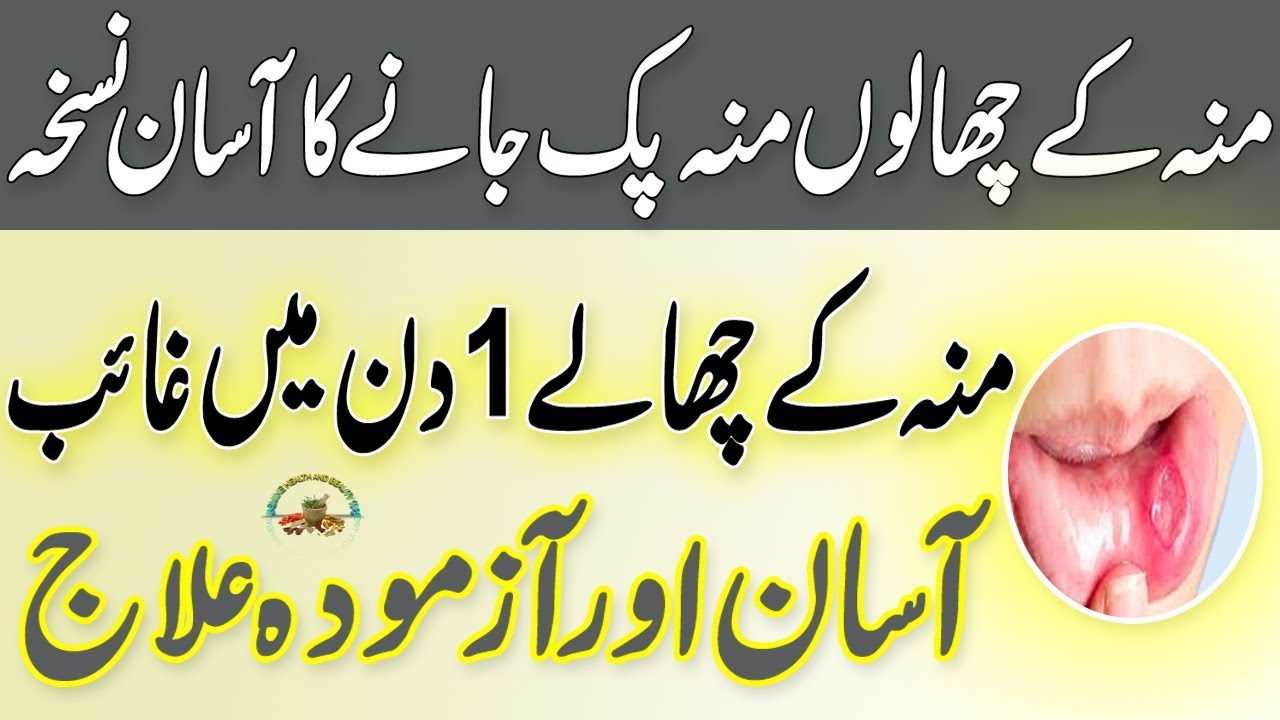 muh ke chale | muh ke chalo ka ilaj | mouth blisters treatment in urdu ...