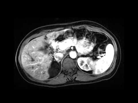 Adrenal cyst