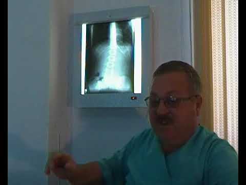 Zaur Eliyev.Manual terapiya.Onurga sutunun eyriliklerinin esas sebebi.