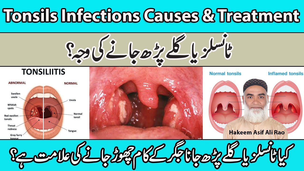 | Tonsil Infections Causes & Treatment | Tonsils Parh Jana | Gale Parh ...
