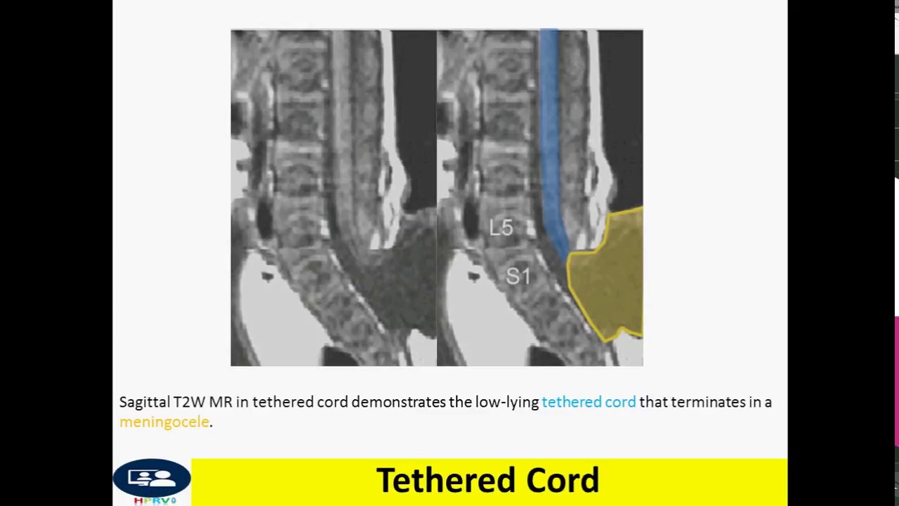 Tethered Cord Imaging - YouTube