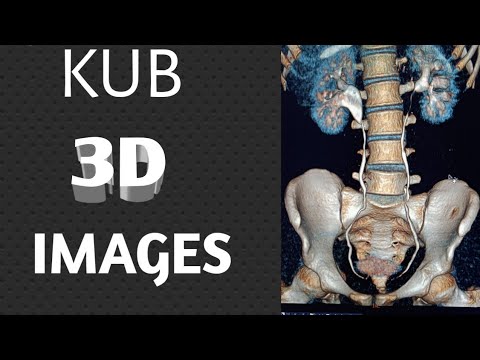 KUB CT SCAN || 3D IMAGES OF KUB CT SCAN || CECT KUB - YouTube