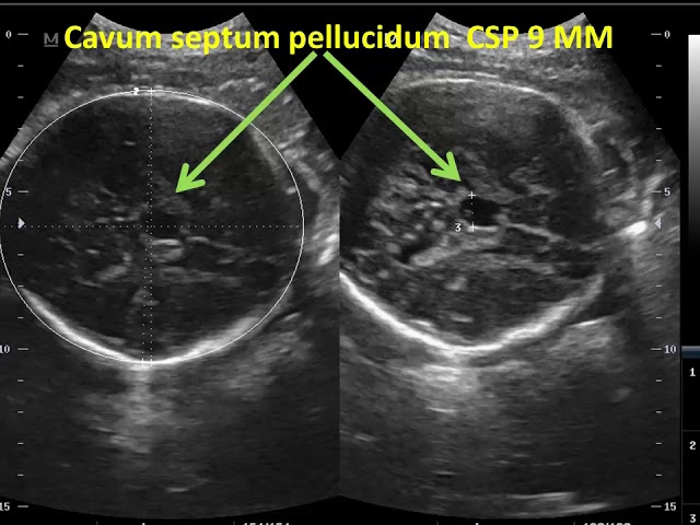 Learning Neuroradiology Case 1404 Cavum Septum International Journal