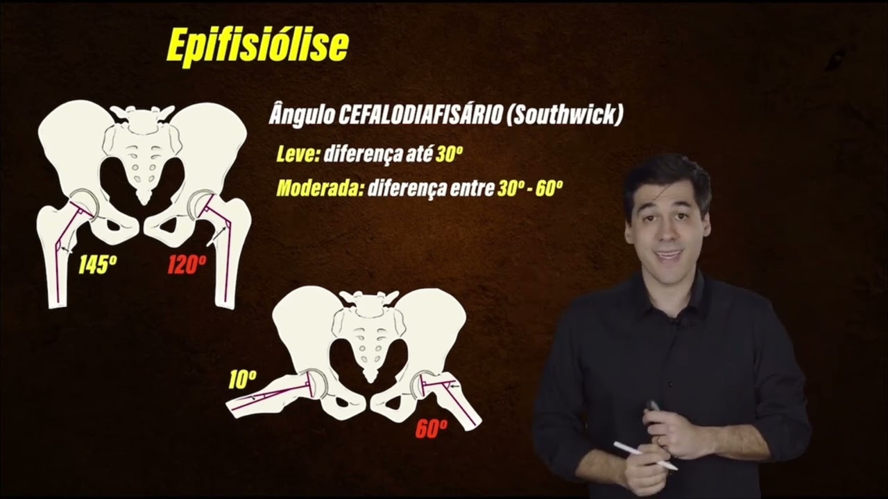 Epifisiólise do fêmur proximal - YouTube