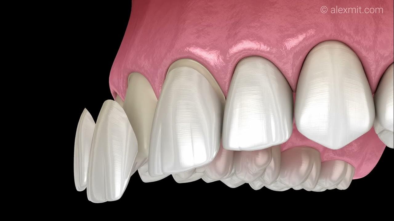 Dental veneer placement over central incisor and lateral incisor, 3D ...