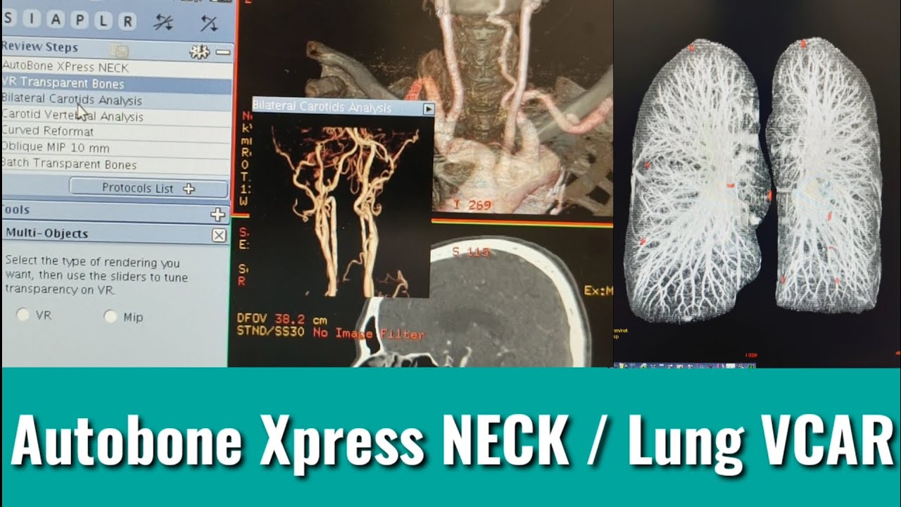 Autobone Xpress Neck and Lung VCAR process and software. - YouTube
